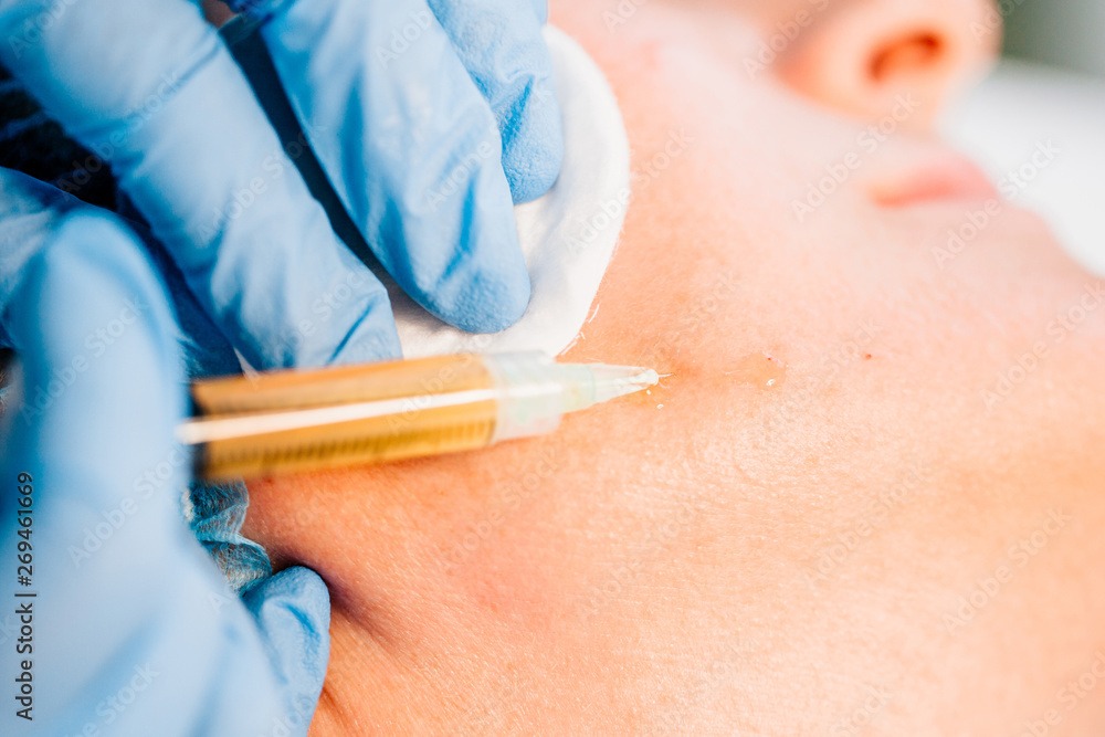 Plasma lifting - injections of blood plasma into the skin in the lower ...