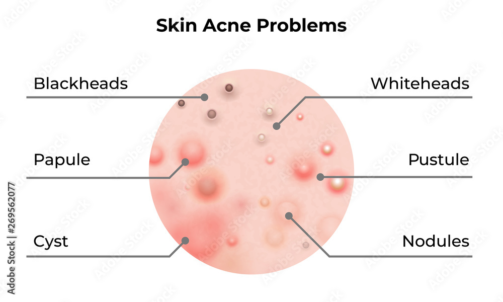 Blackhead Diagram