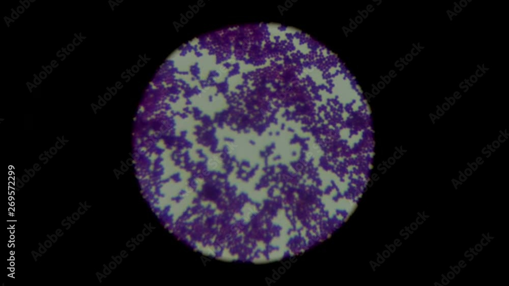 Smear of biological sample culture Gram's stained with gram positive ...