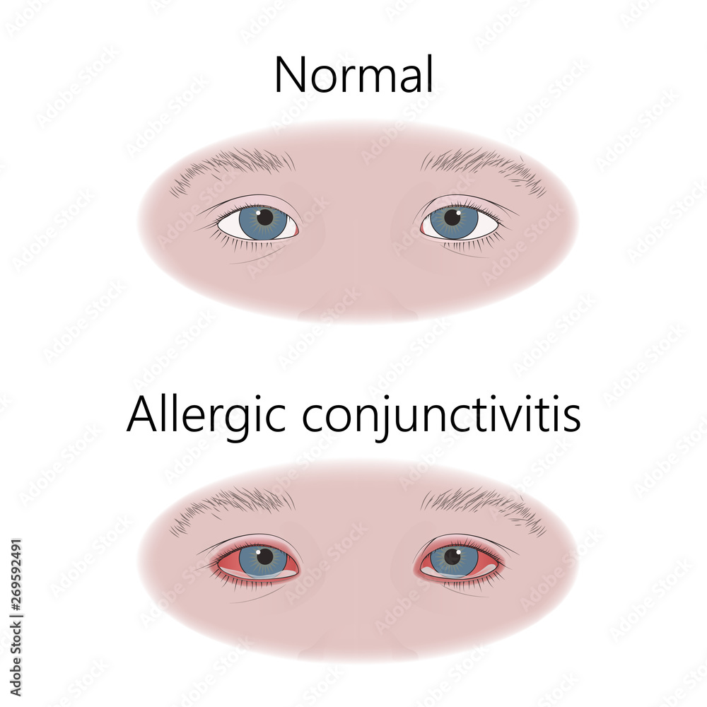 Allergic conjunctivitis. Allergy. Comparison with normal. Vector flat ...