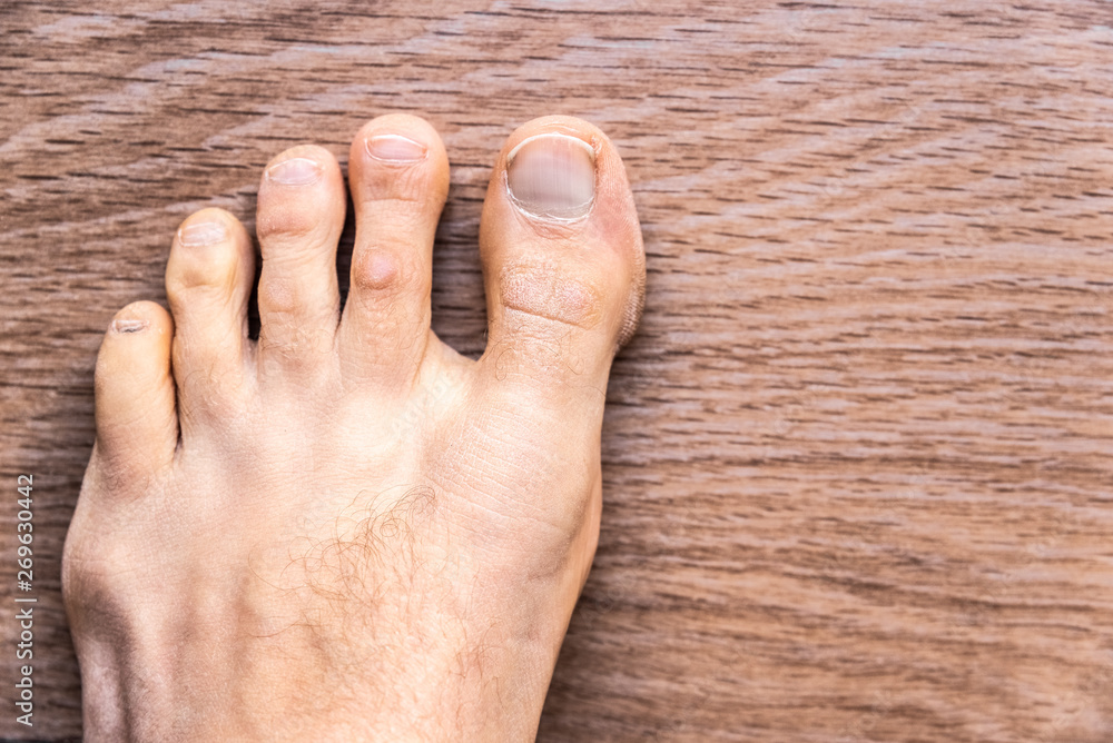 Toes affected by dermal problems, red rash produced plaques of ...