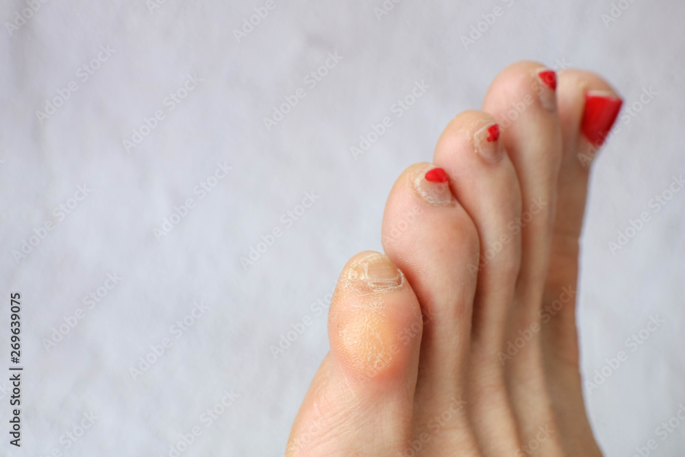 Feet and toes in poor condition/In need of a pedicure/Feet and toes of ...