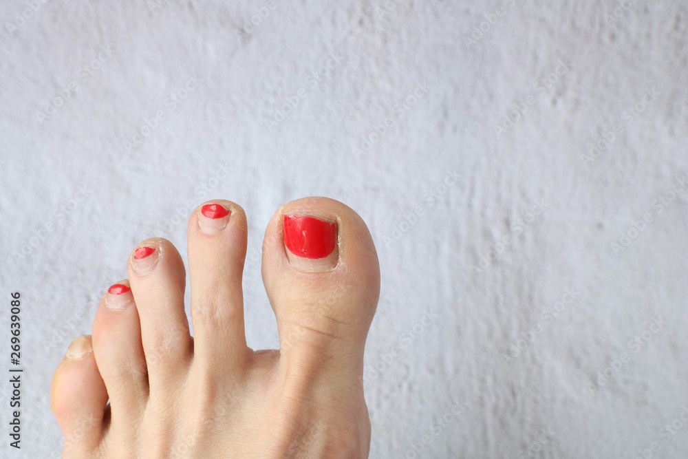 Feet and toes in poor condition/In need of a pedicure/Feet and toes of ...