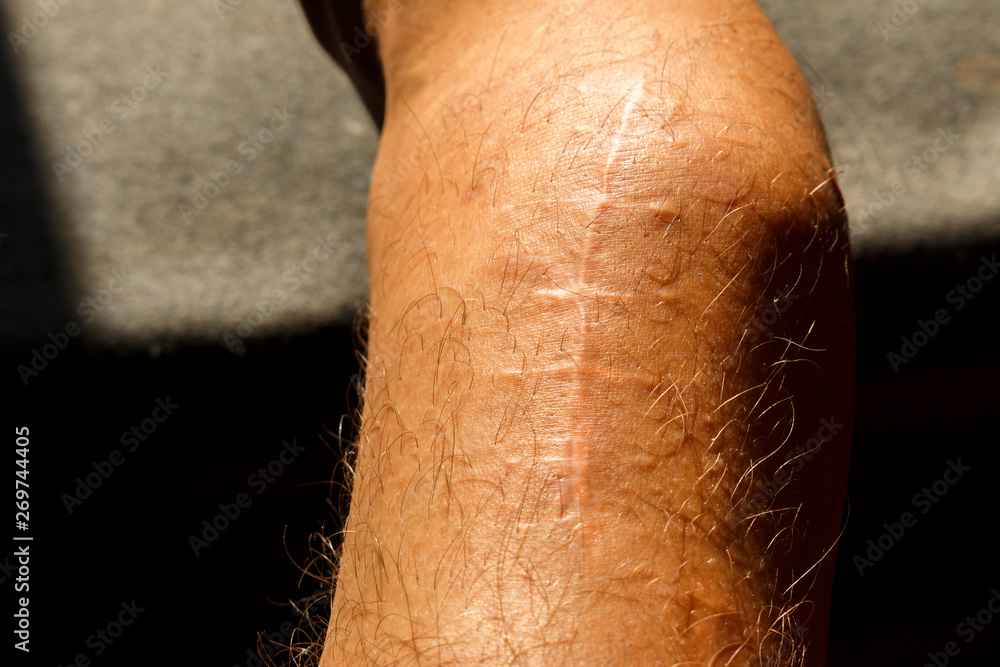 scar on the leg. Human leg with old postoperative scar of Shin joint ...