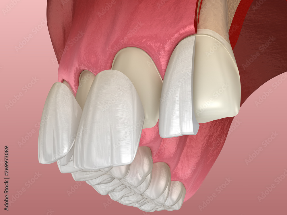 Veneer installation procedure over central incisor and lateral incisor ...