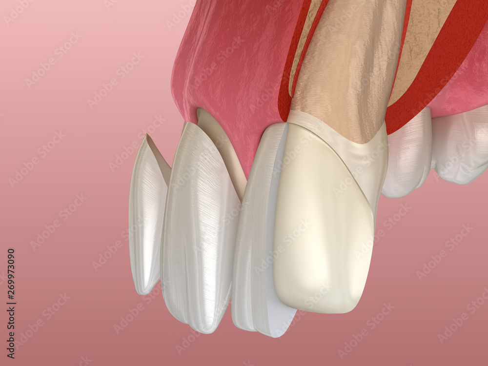 Veneer installation procedure over central incisor and lateral incisor ...