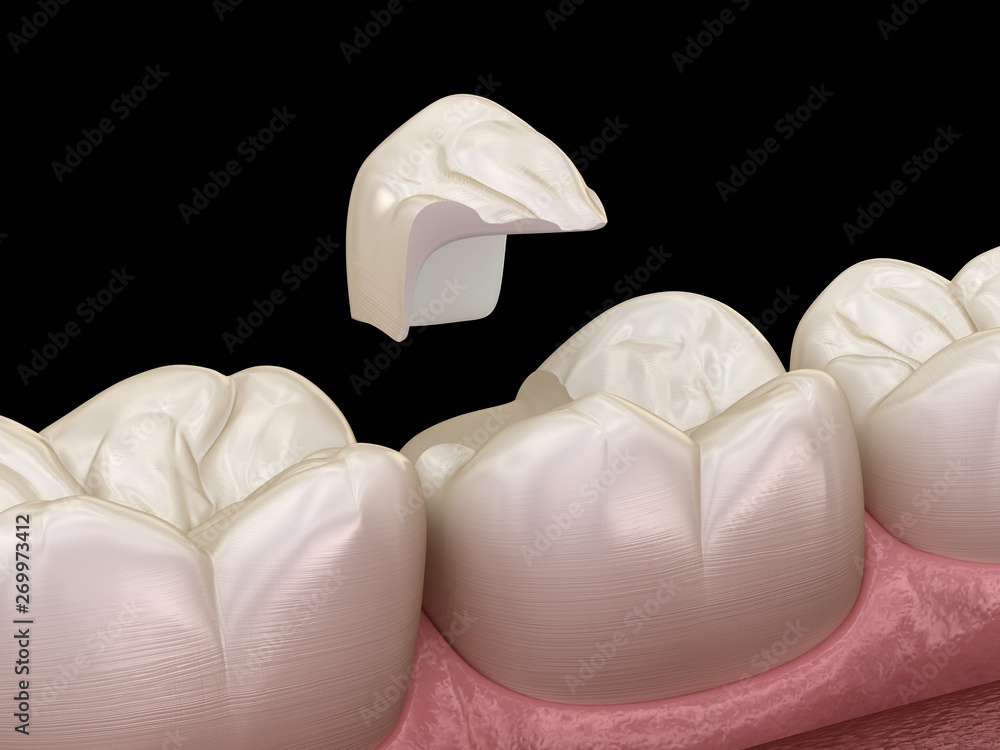Onlay ceramic crown fixation over tooth. Medically accurate 3D ...