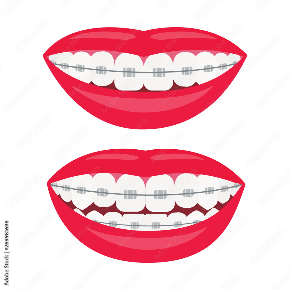 Dental Braces. Smile with braces on the teeth. Alignment of bite of ...
