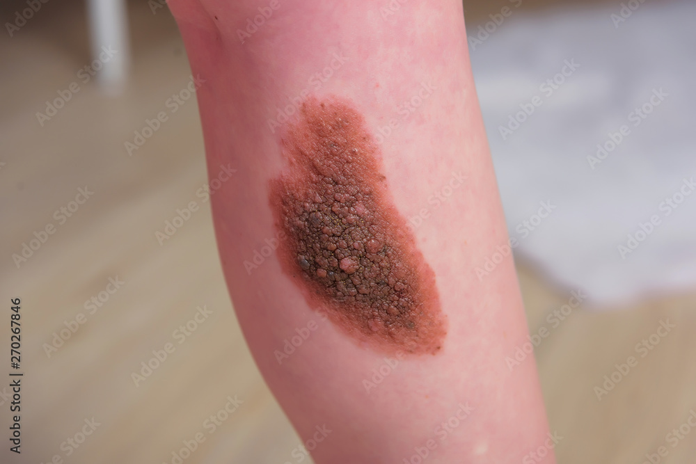 A large birthmark on a person's leg. Pigmented formation on the skin ...