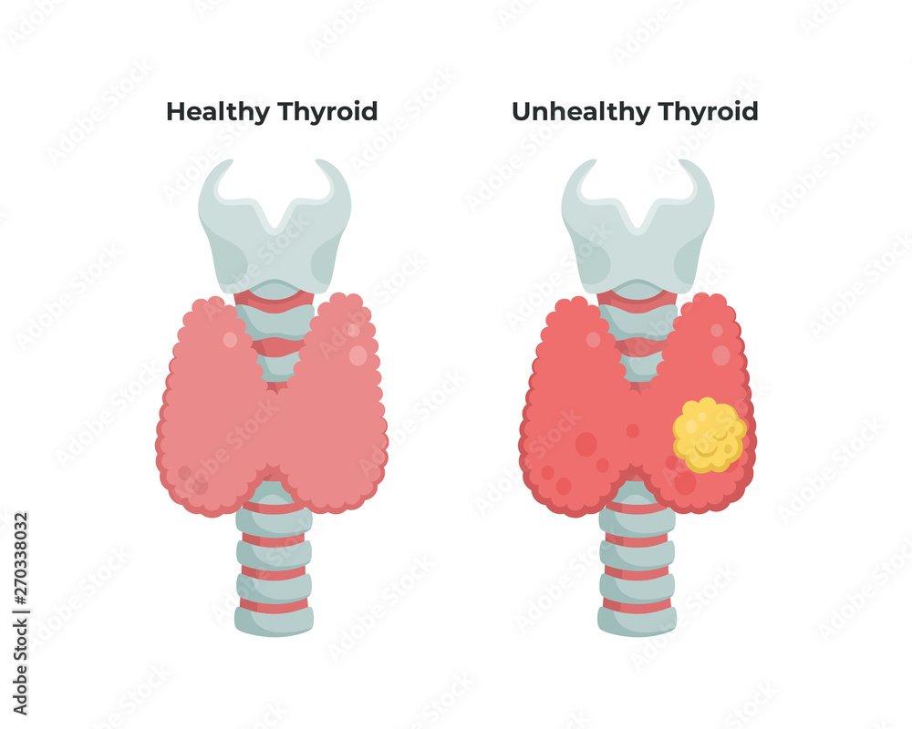 Healthy Thyroid gland and unhealthy thyroid with Inflammation and lump ...