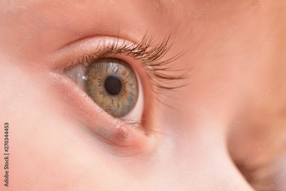 Children's right eye and swollen barley on the lower eyelid. Macro ...
