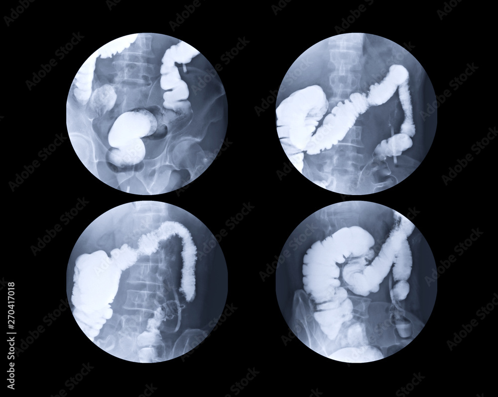 spot film of BE or. barium enema Single contrast image showing a rectal ...