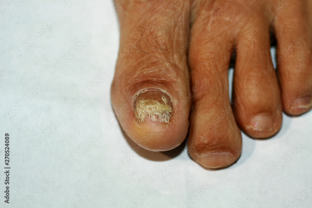 Fungus on the big toe. Fungal disease on the nail psoriasis Stock Photo ...
