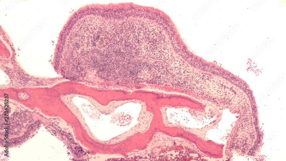 Microscopic image of tissue from endoscopic sinus surgery of the ...