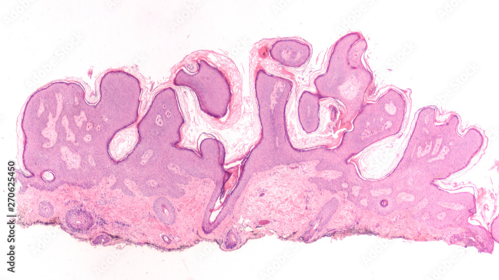 Skin biopsy micrograph of seborrheic keratosis, a benign wart-like ...