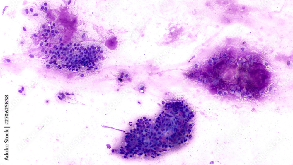 Fine needle aspiration (FNA) cytology of pleomorphic adenoma ("mixed ...