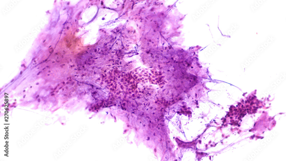 Pleomorphic Adenoma Cytology