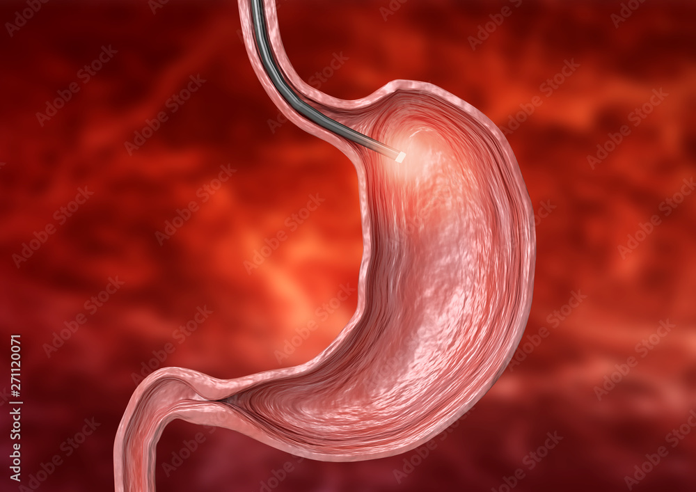 digestive endoscopy - examination using flexible tube with camera and ...
