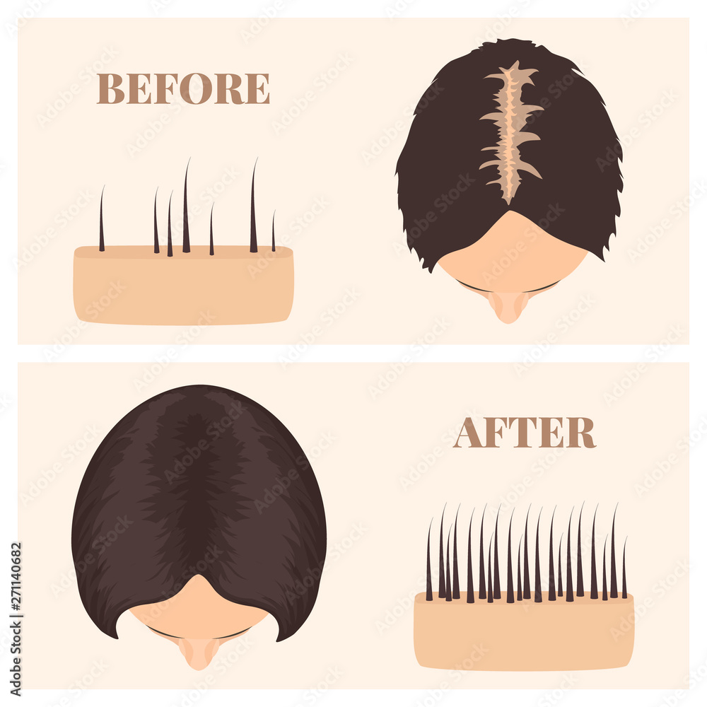 Woman with thinning hair before and after hair regrowth. Female pattern ...