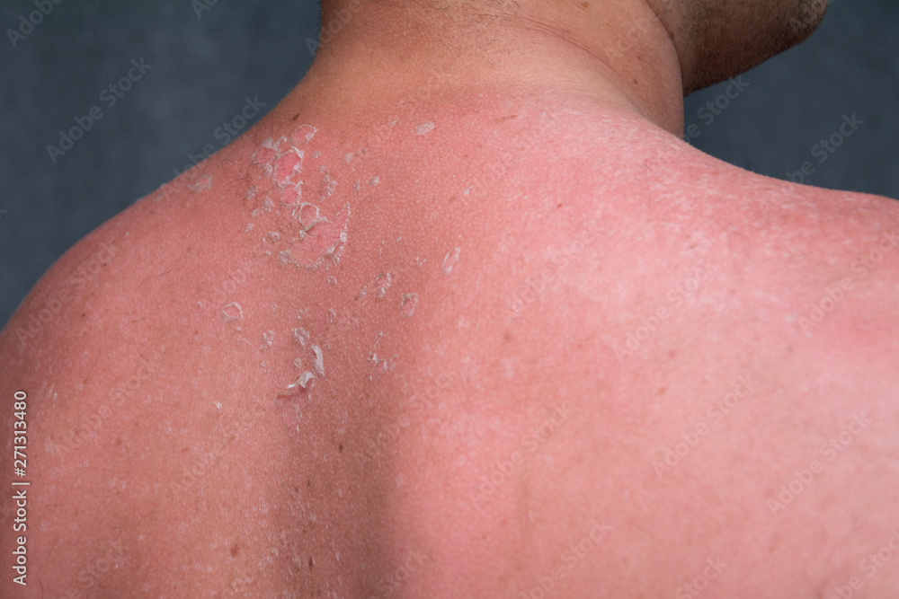 Peeling Skin At Back And Shoulder From Sunburn Effect On Body Of Young