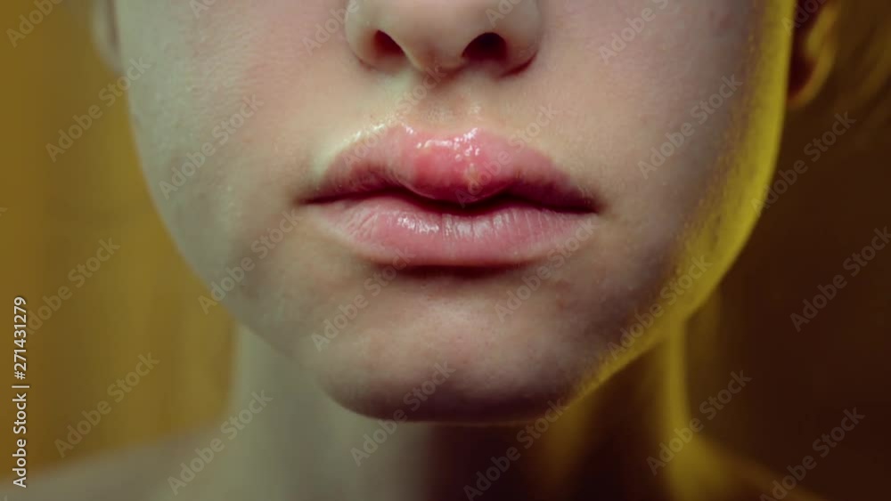 Herpes on the Upper Lip of a Young Woman. Medical Background of a Young ...