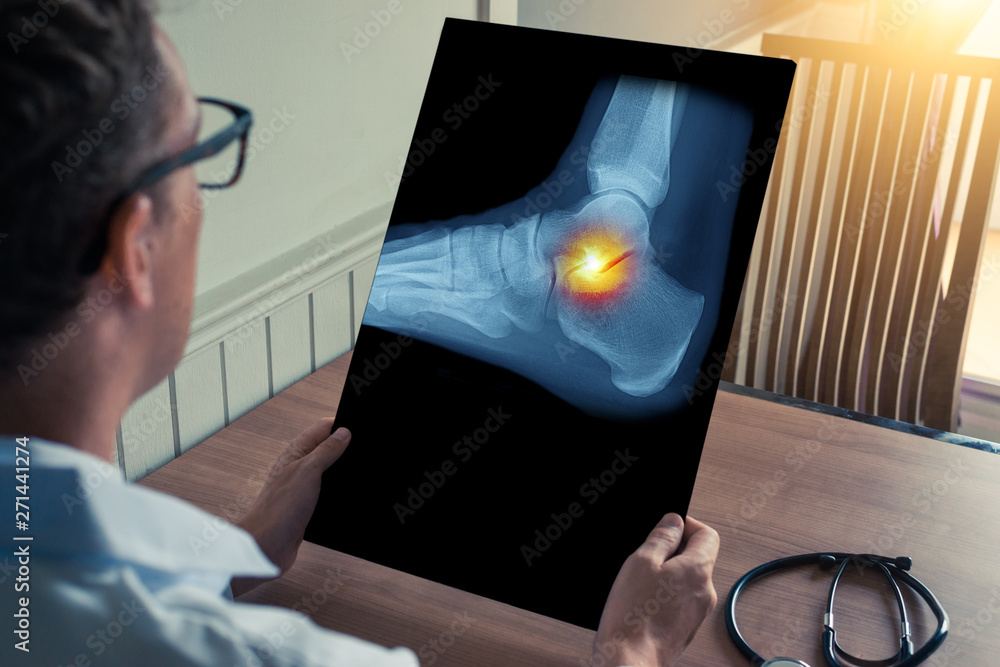 Doctor holding a x-ray of foot and pain on the ankle in medical office ...