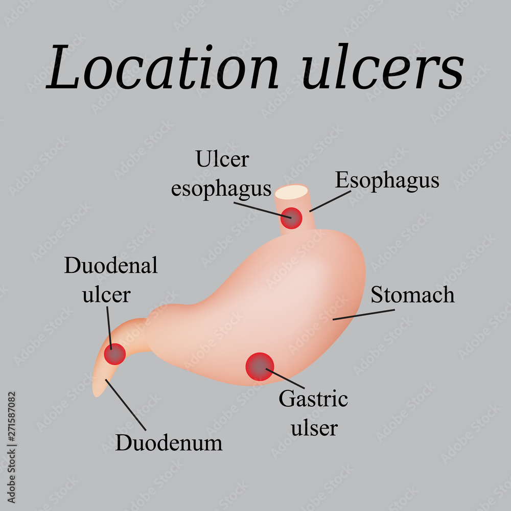 Esophagus ulcer affected. Ulcer of esophagus. Stomach ulcer affected ...