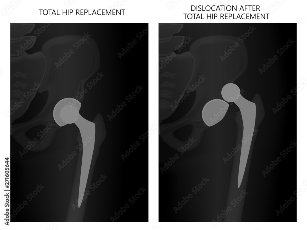 Vector illustration x-ray Pelvis and Hip joint, dislocation after total ...
