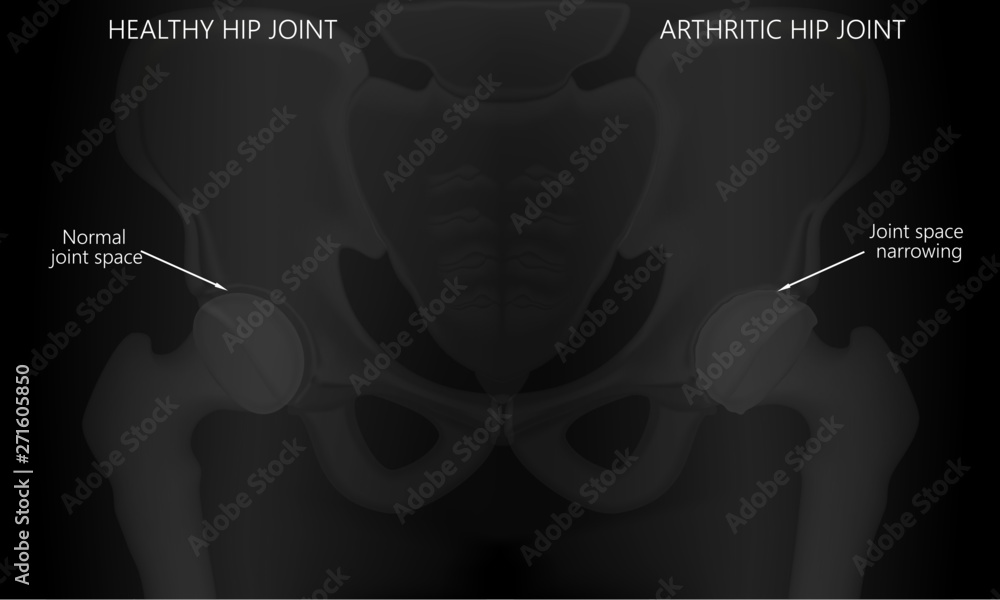 Vector illustration x-ray of human healthy hip and pain in arthritic ...