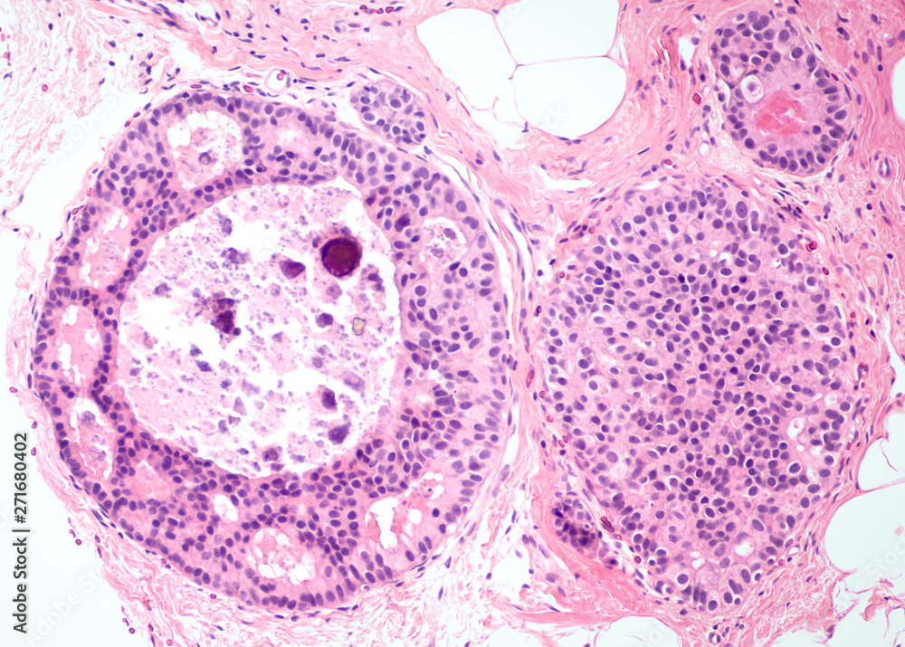 Breast cancer core biopsy - ductal carcinoma in situ (DCIS) detected by ...