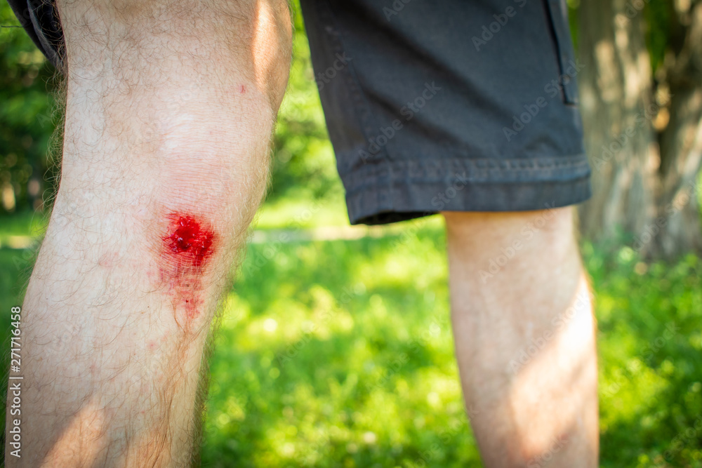 Emergency accident open abrasion wound trauma skin leg knee. People ...