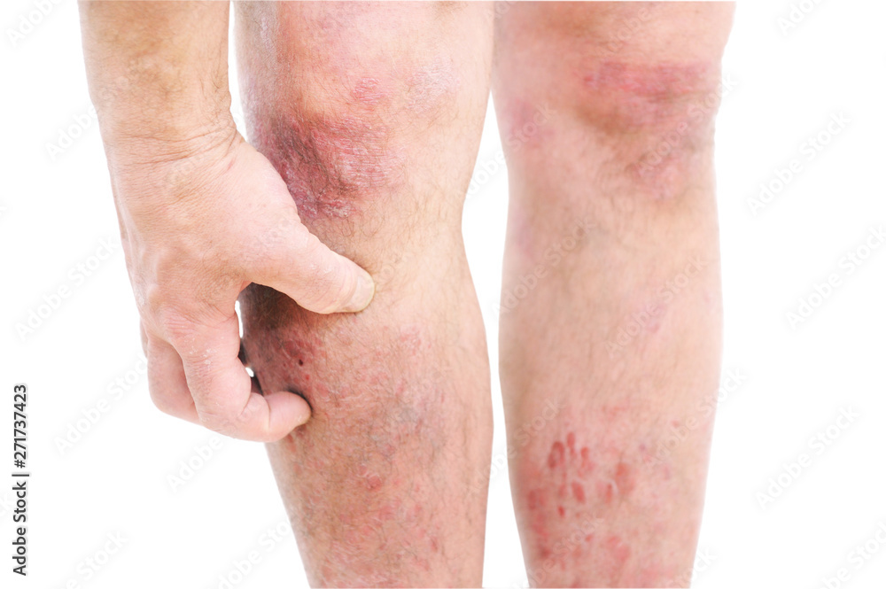 Atopic dermatitis (AD), also known as atopic eczema, is a type of skin ...