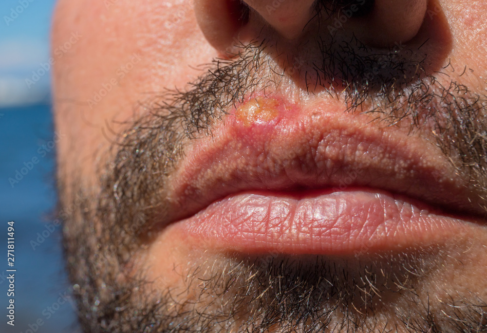 Bacterial Infection On Lips