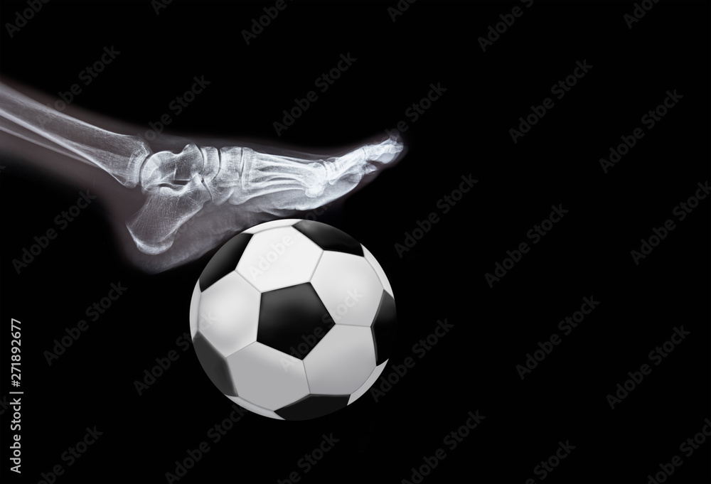 Soccer player's health concept - X-ray normal human's foot with soccer ...