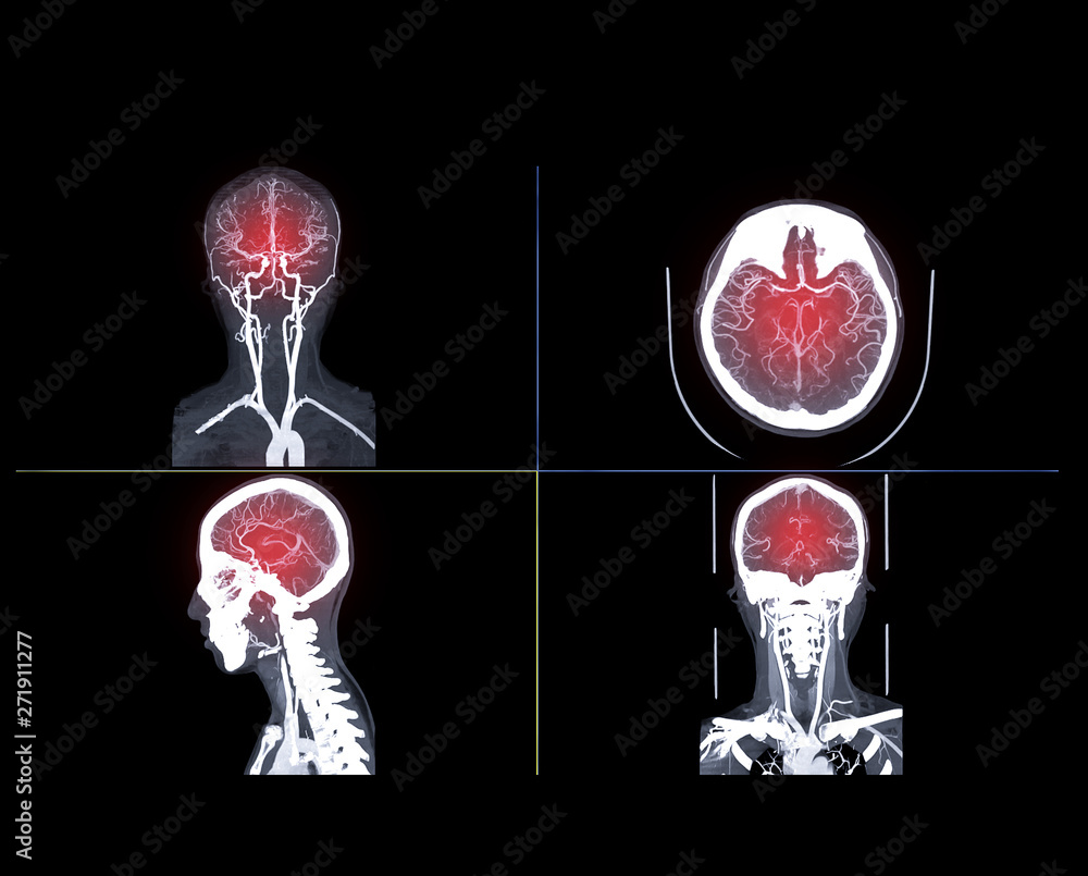 CTA brain or CT angiography of the brain comparison Coronal and ...
