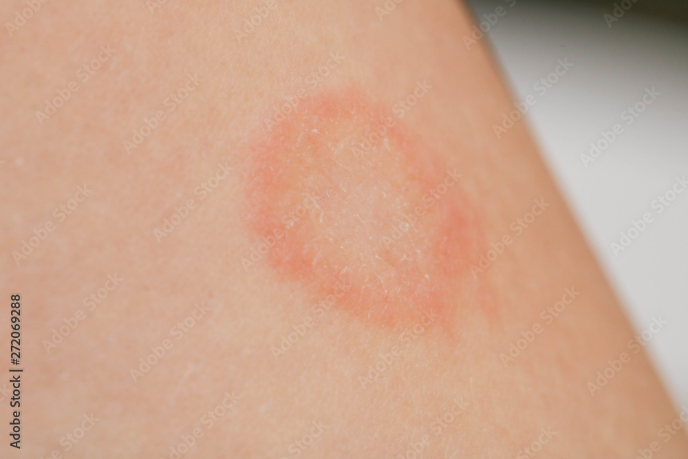 Mycosis infection on the human skin. It is caused by a fungus Stock ...