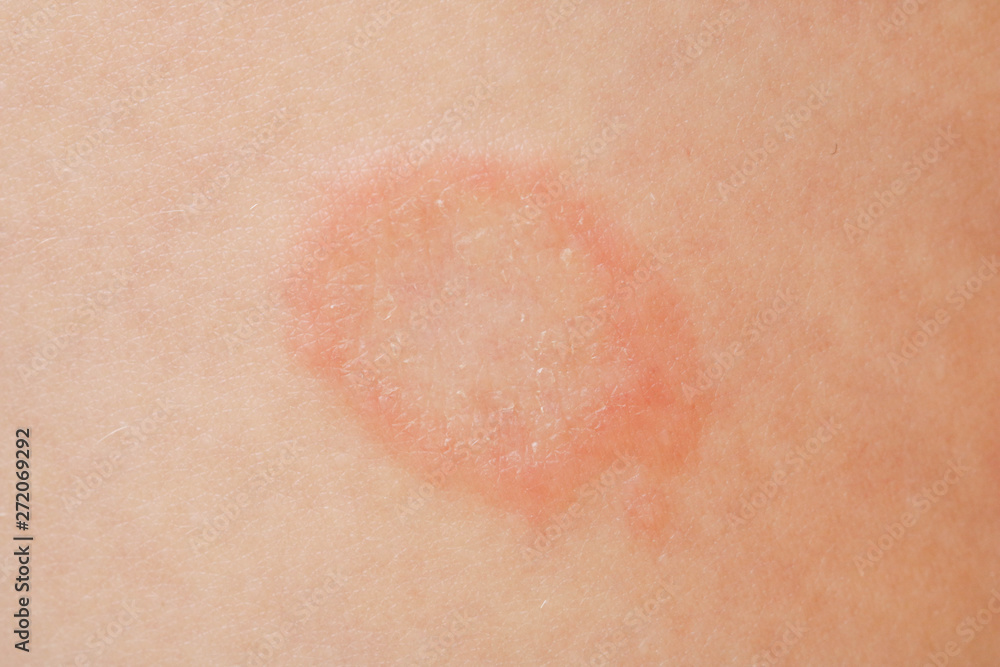 Mycosis infection on the human skin. It is caused by a fungus Stock ...