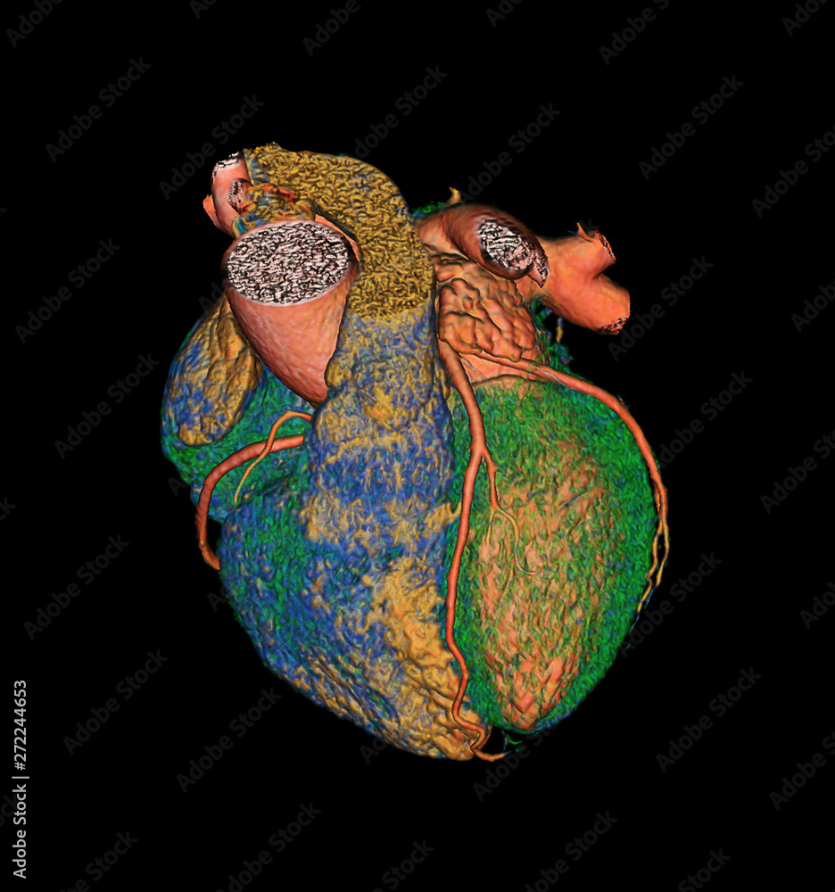 CTA Coronary artery 3D rendering image for finding coronary artery ...