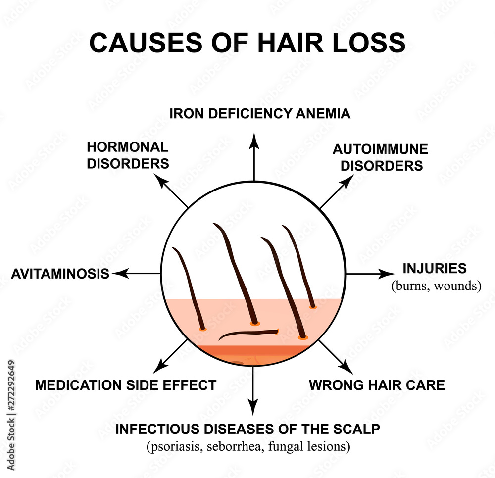 Causes of hair loss. The structure of the skin and hair. Infographics ...