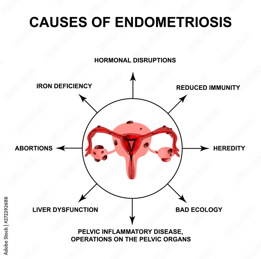 Causes Of Endometriosis Adenomyosis The Structure Of The Pelvic