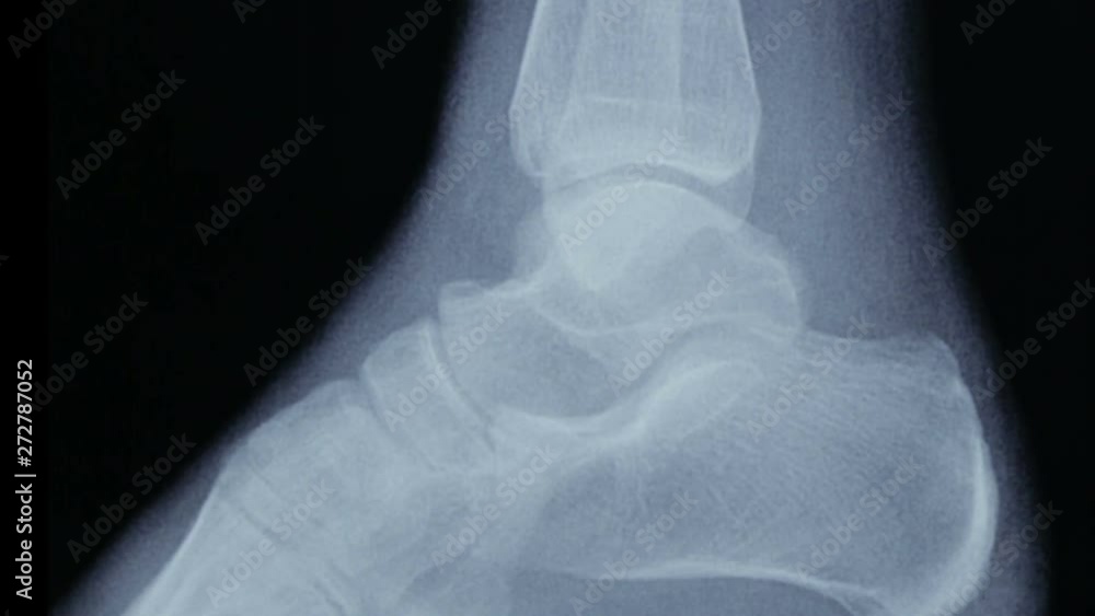 Vertical tracking, of a radiograph of the foot, tibia and human fibula ...