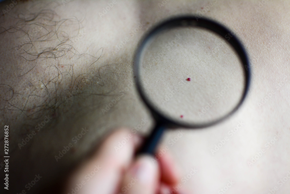Foto de Red mole or wart on the men skin. Birth marks on the body.Close ...