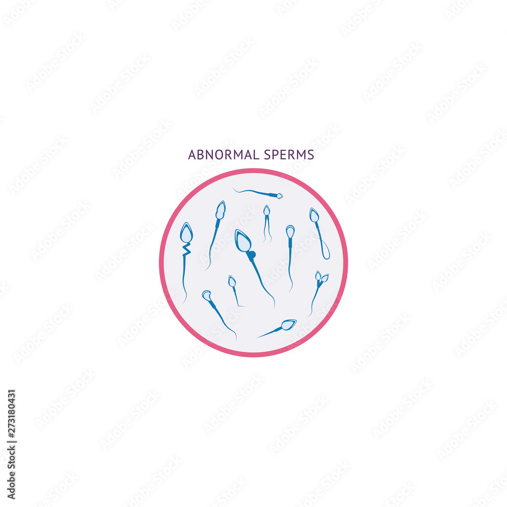 Abnormal spermatozoids morphology flat vector illustration isolated on ...