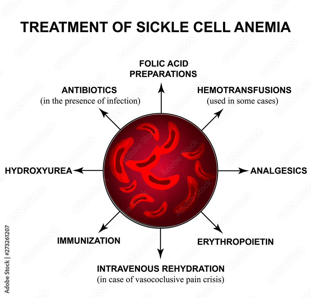 Vecteur Stock Treatment of sickle cell anemia. World Sickle Cell Anemia ...