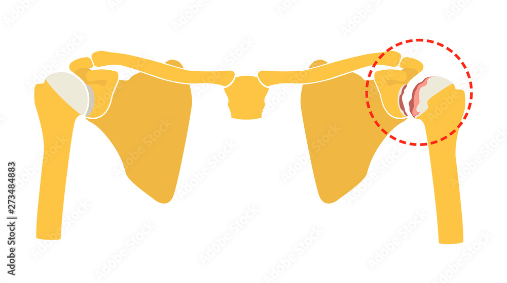 Osteoarthritis of the shoulder joint, degeneration of joint cartilage ...