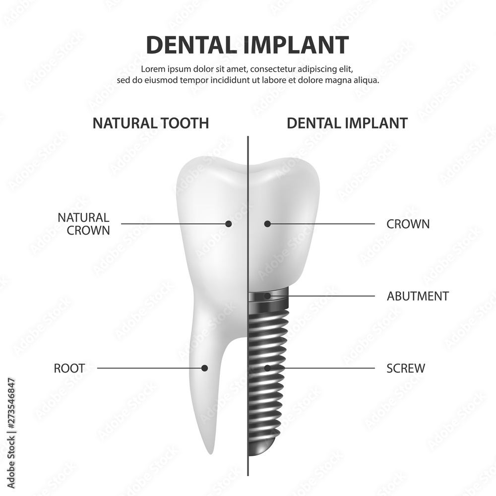 Vector 3d Realistic Render White Tooth Implant Denture Closeup Isolated ...