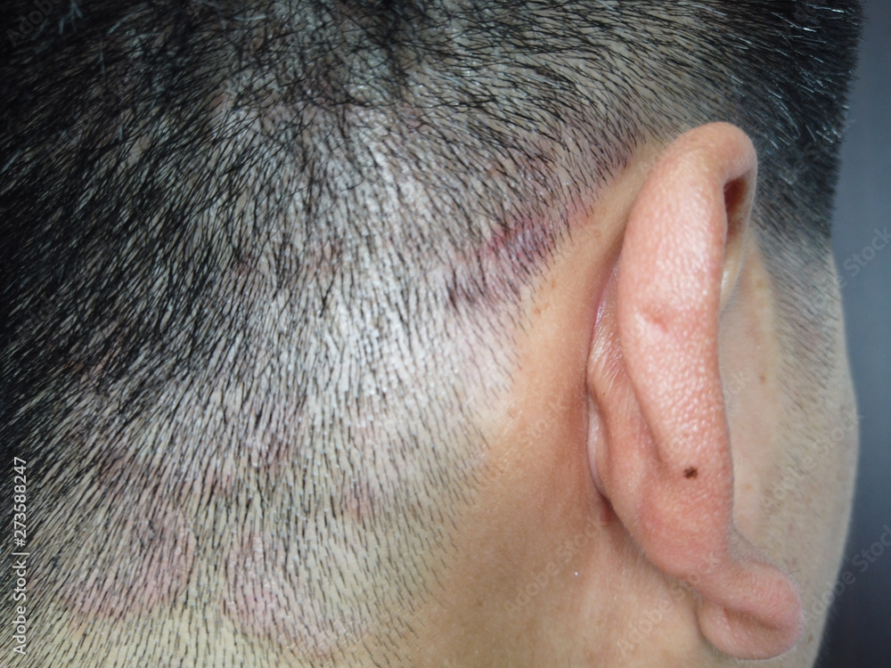 Foto de Closed up of ringworm (tinea) on head of asian man (Dermatitis ...