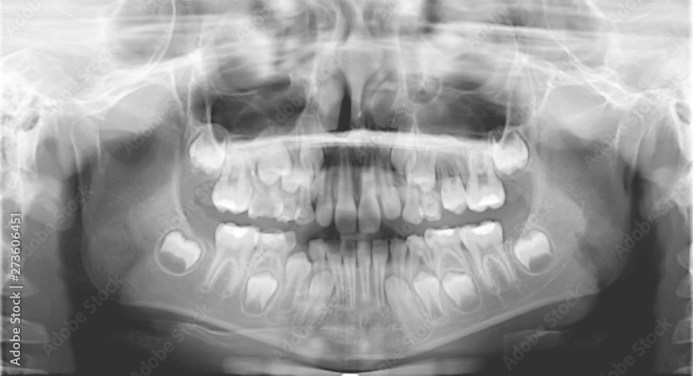 Stockfoto med beskrivningen X-ray scan of children's jaw teeth ...