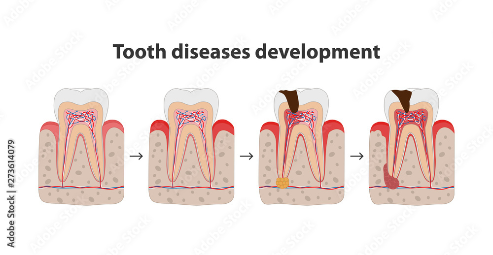 Development of tooth disease medical poster illustration in flat design ...