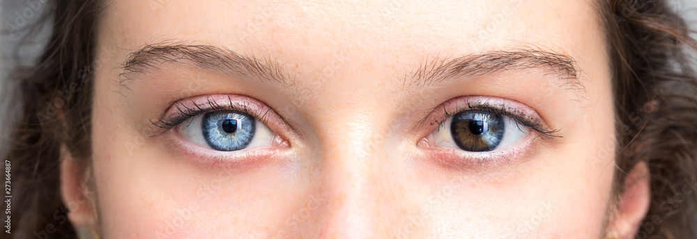 Human heterochromia on eyes of girl, blue one and brown one Stock Photo ...
